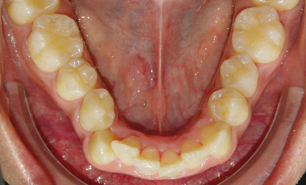 Extraction d’une incisive mandibulaire – L'Information Dentaire Extraction d’une incisive mandibulaire – L'Information Dentaire