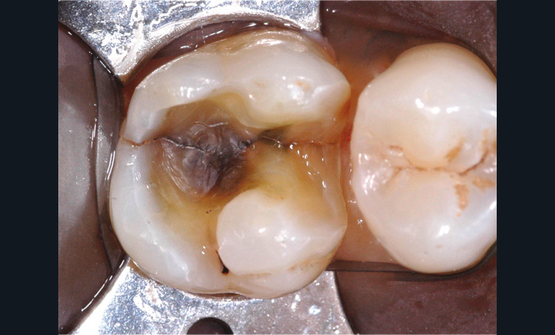 Traitements des fêlures : invasivité minimum ou risque minimum ? – L ...