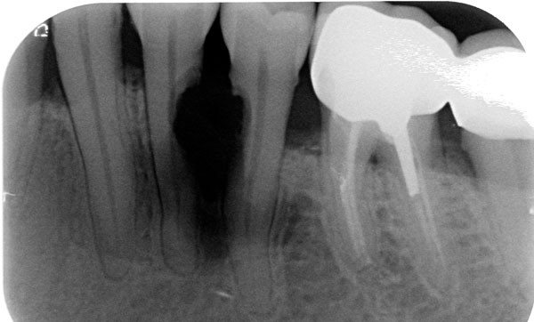 À propos d’une lésion radioclaire alvéolaire mandibulaire – L ...