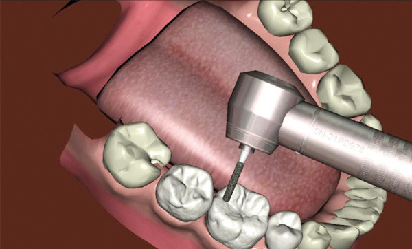 Le Simodont : l’outil d’apprentissage d’avenir ? – L'Information Dentaire