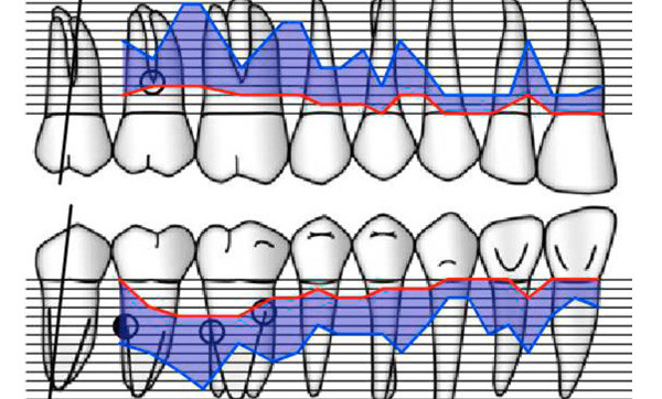 Précision : nouvelle classification des maladies parodontales – L ...