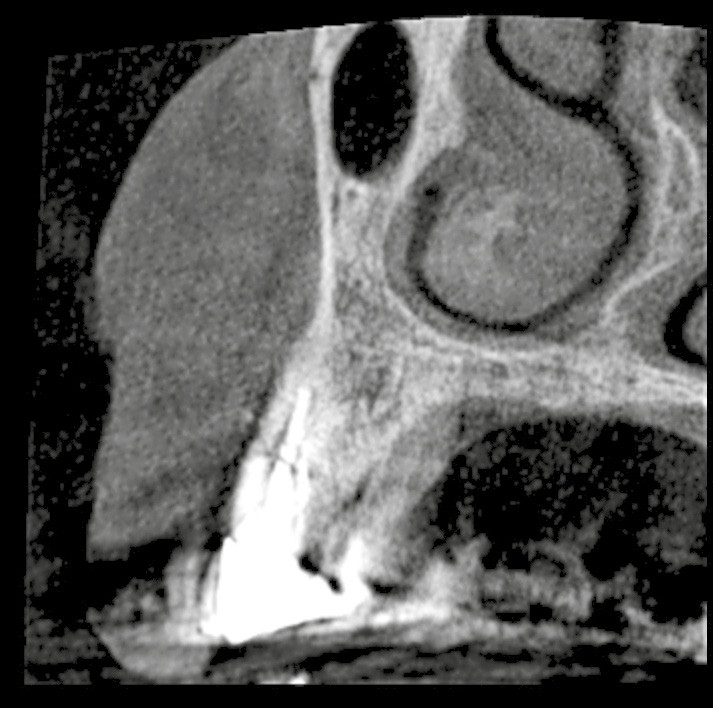 L’extraction implantation immédiate en présence d’un déficit osseux ...
