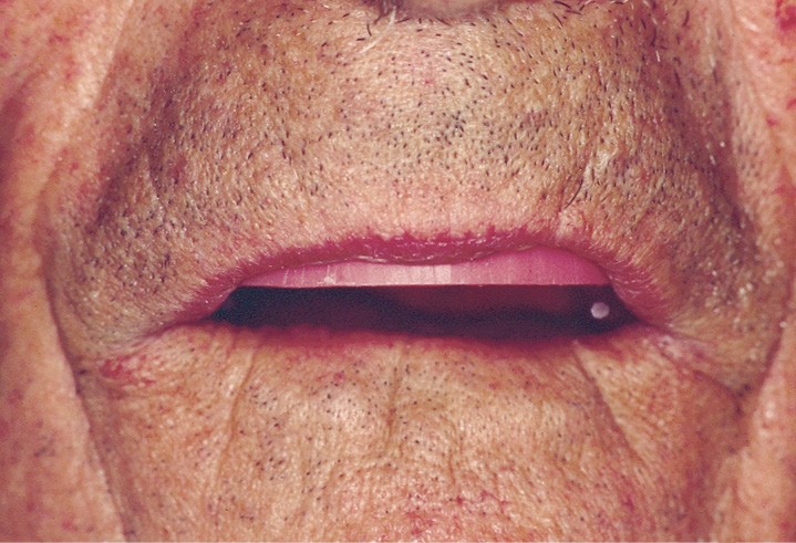 Le transfert du modèle maxillaire sur articulateur en prothèse amovible complète : table ou arc ...