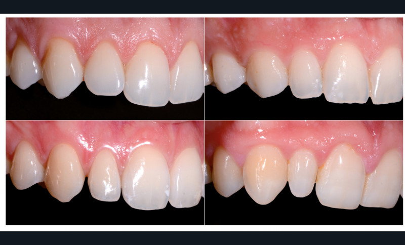L’incisive latérale maxillaire, une dent capricieuse – L'Information ...