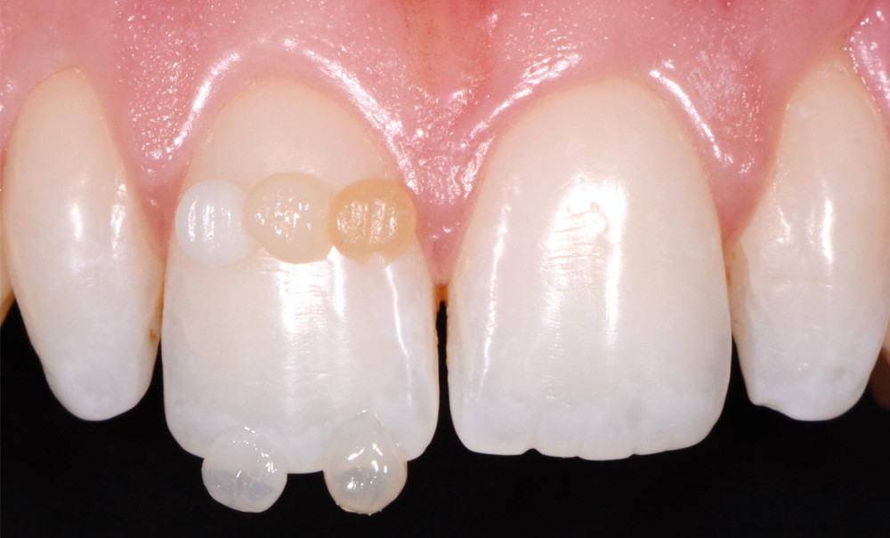 Restaurations directes d’incisives latérales maxillaires riziformes par ...