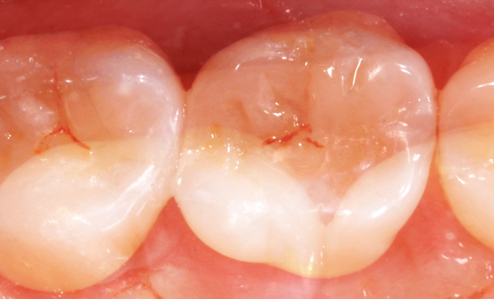 Inlays, onlays, overlays du direct à l’indirect : comment définir l ...