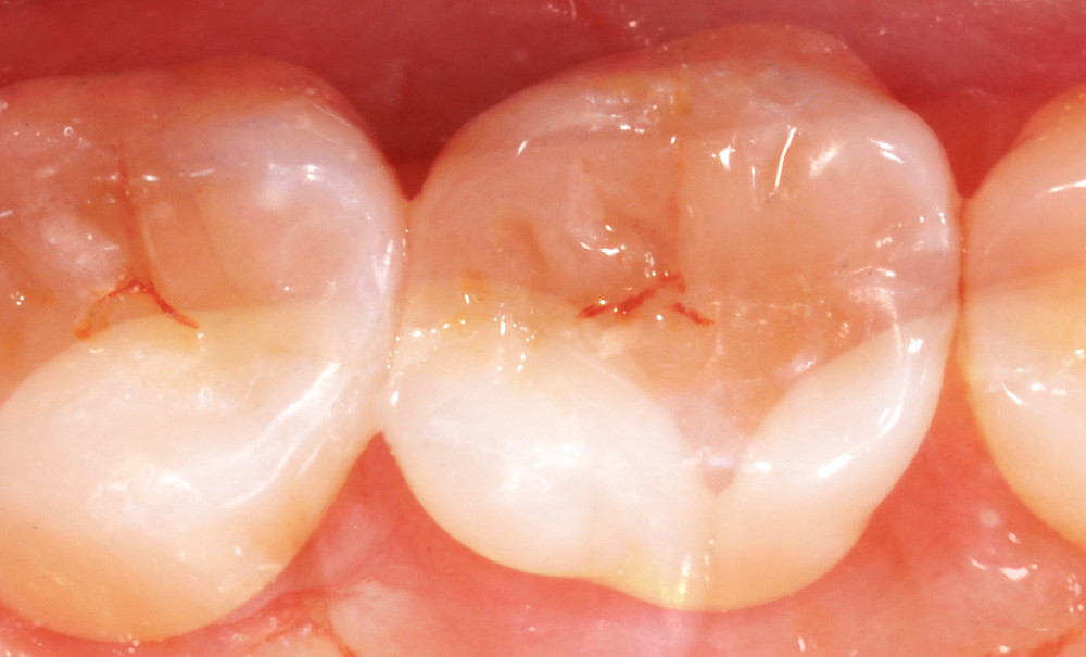 Inlays, onlays, overlays du direct à l’indirect : comment définir l ...