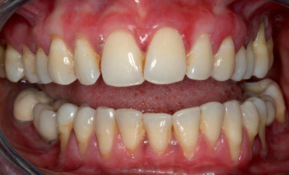 Gingivite « réfractaire » : conduite à tenir – L'Information Dentaire