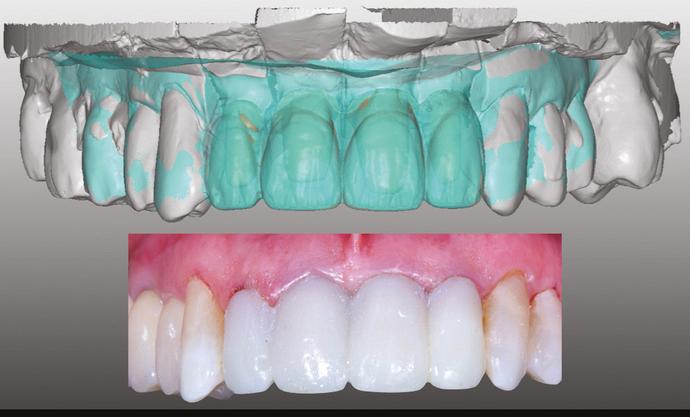 Restaurations esthétiques grâce à la technique du cut-back – L ...