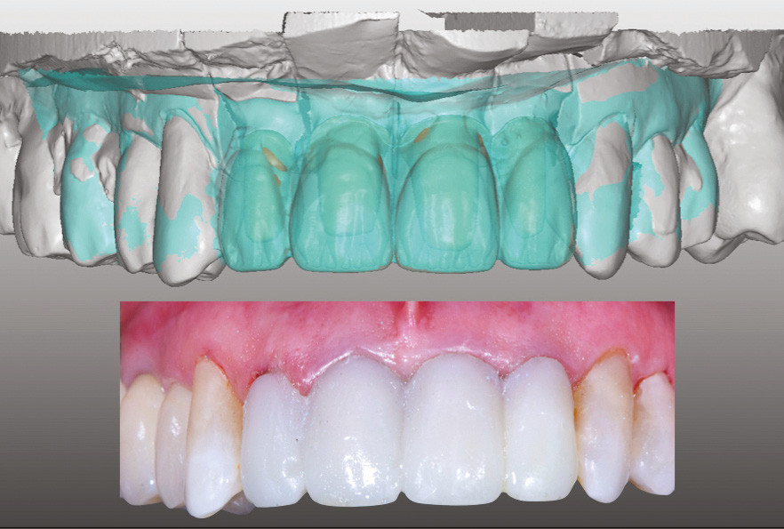 Restaurations esthétiques grâce à la technique du cut-back – L ...