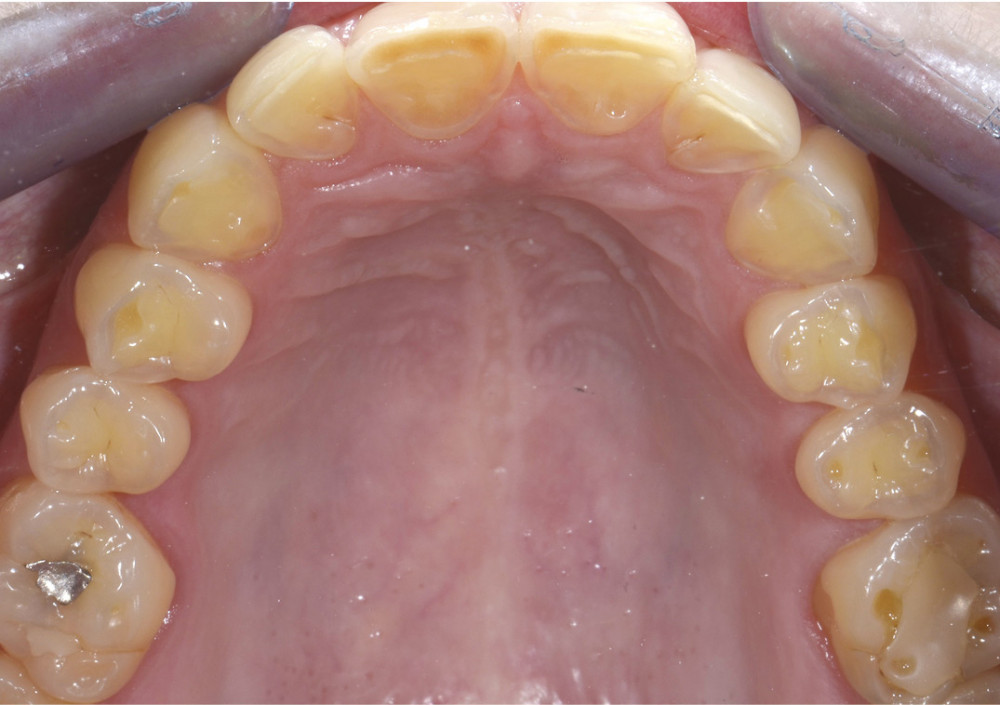 Restauration des conséquences de l’usure par technique adhésive sans ...