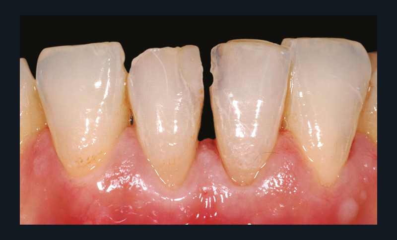 Les composites antérieurs en technique directe – L'Information Dentaire