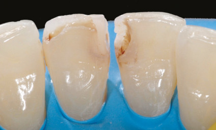 Les composites antérieurs en technique directe – L'Information Dentaire