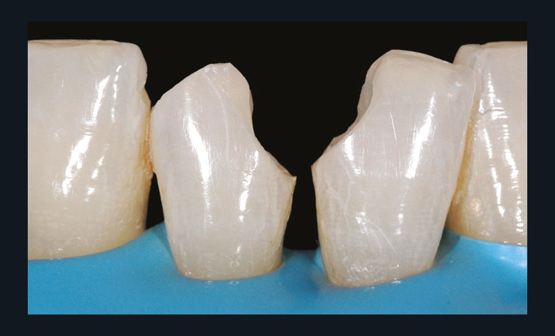 Les composites antérieurs en technique directe – L'Information Dentaire