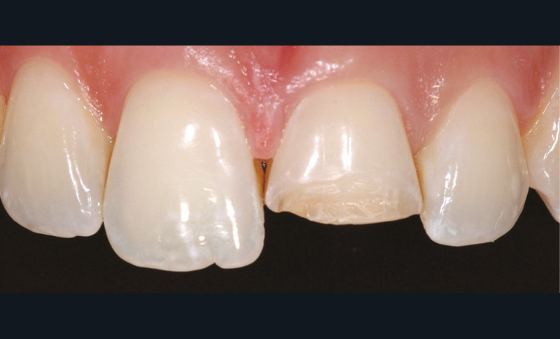 Les composites antérieurs en technique directe – L'Information Dentaire