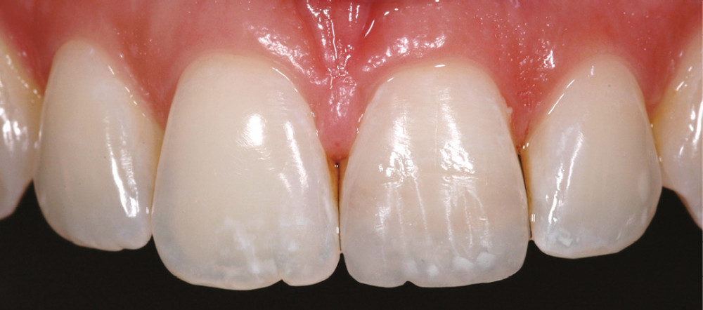 Les composites antérieurs en technique directe – L'Information Dentaire