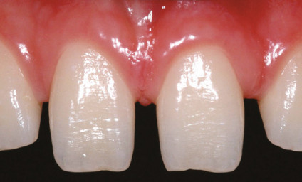 Les composites antérieurs en technique directe – L'Information Dentaire
