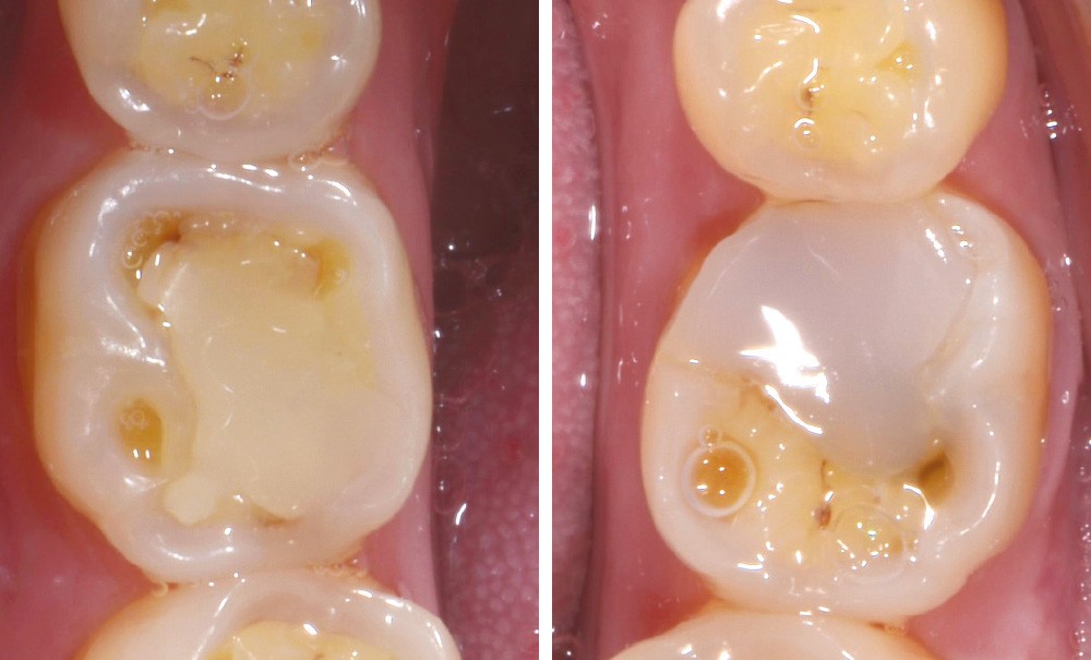 Restauration des conséquences de l’usure par technique adhésive sans ...