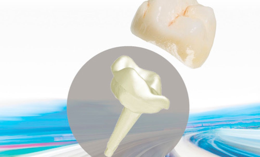 Inlay-core composite en fibres de verre – Protilab – L'Information Dentaire