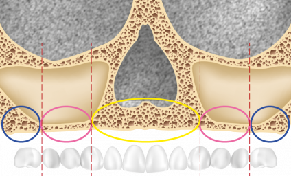 Traitement du maxillaire fortement résorbé à l’aide d’implants ...