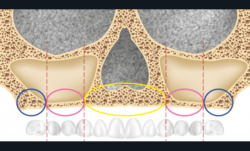 Traitement du maxillaire fortement résorbé à l’aide d’implants ...