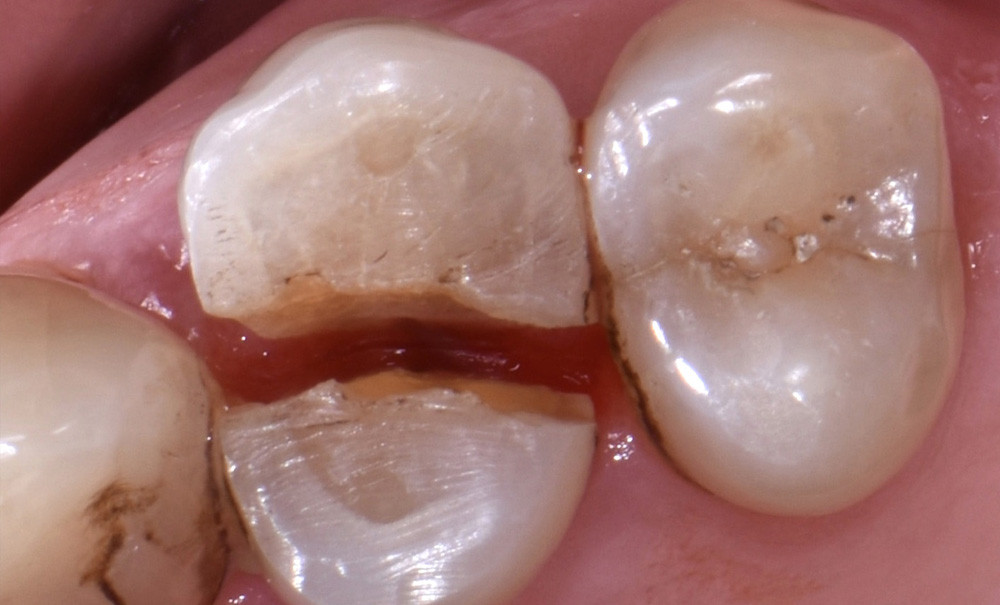 Jusqu’où peut-on conserver dans les cas de fêlures ? – L'Information ...