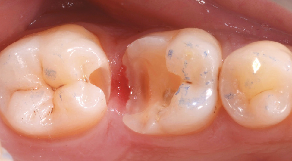 Inlays, onlays, overlays : Quand faut-il recouvrir une paroi résiduelle ...