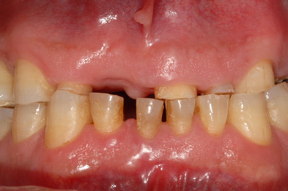 Étiologie des lésions d’usure amélaires – L'Information Dentaire