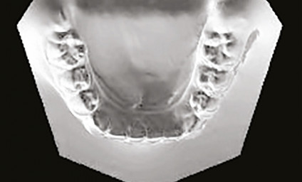 Traitement d’une malocclusion de Classe II/2 – L'Information Dentaire