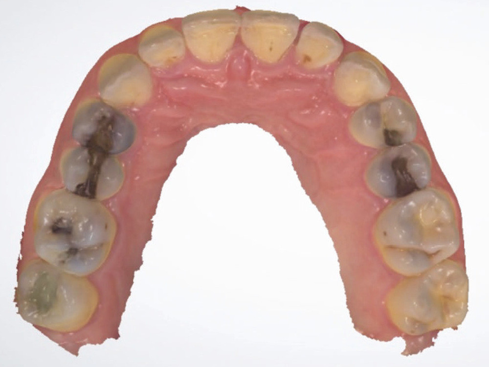 Utilisation d’un scanner intra-oral et d’un processus digital pour la ...
