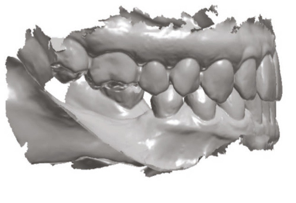 Utilisation d’un scanner intra-oral et d’un processus digital pour la ...