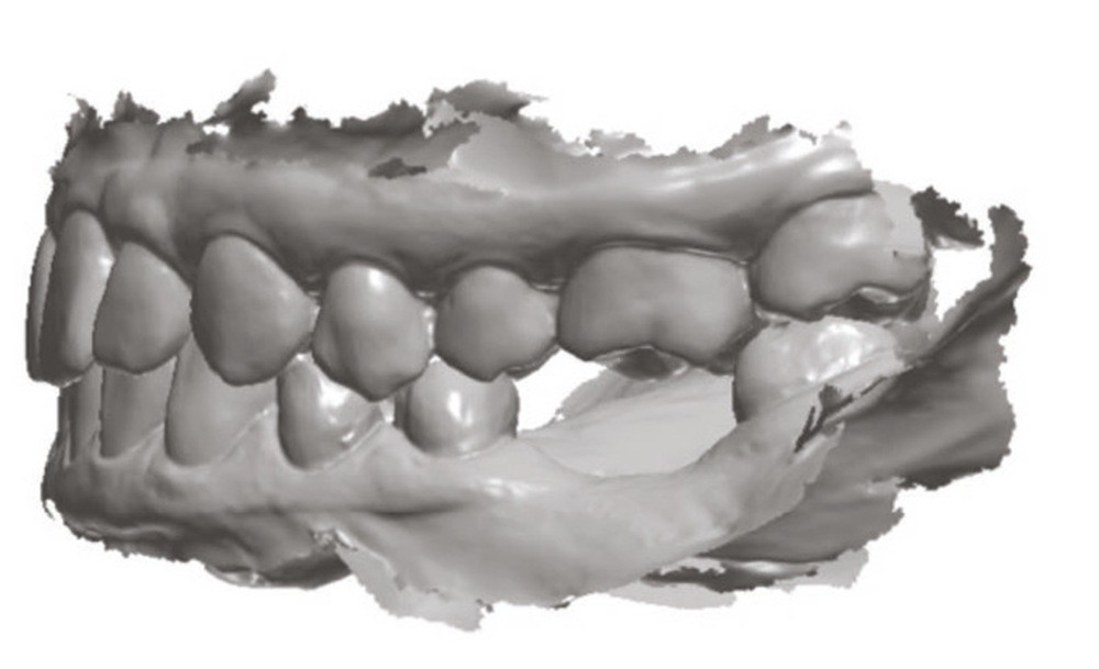 Utilisation d’un scanner intra-oral et d’un processus digital pour la ...