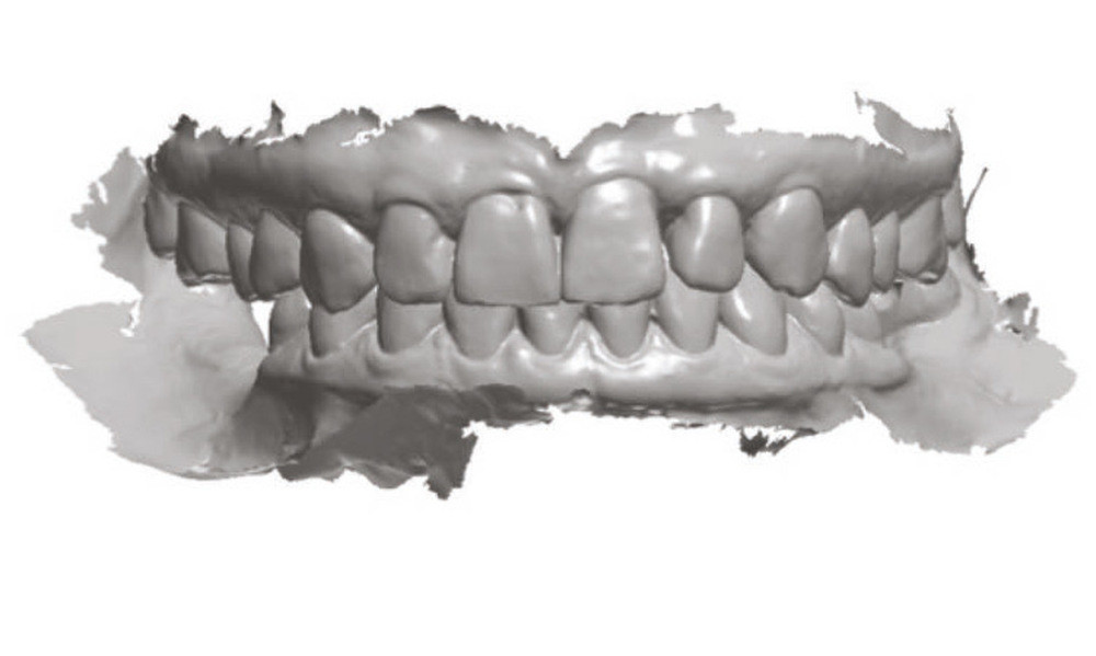 Utilisation d’un scanner intra-oral et d’un processus digital pour la ...