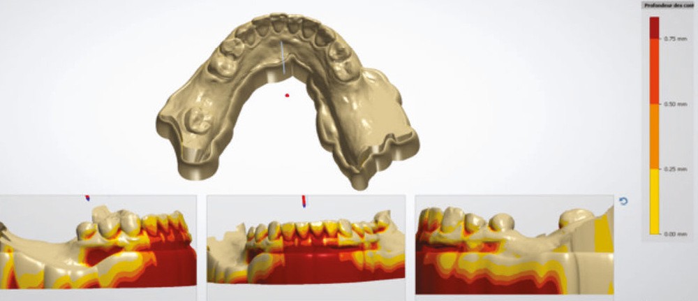 Utilisation d’un scanner intra-oral et d’un processus digital pour la ...