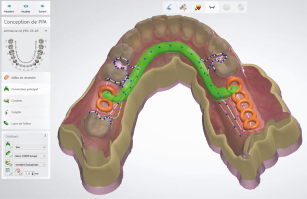 Utilisation d’un scanner intra-oral et d’un processus digital pour la ...