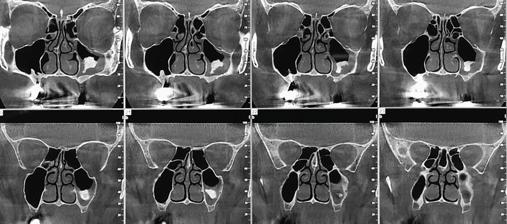 À propos d’une sinusite maxillaire chronique – L'Information Dentaire