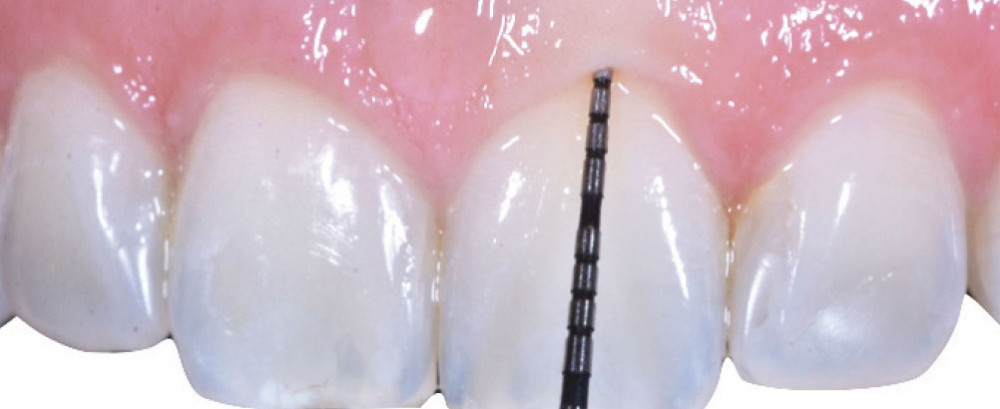 Nouvelle classification… et santé parodontale – L'Information Dentaire