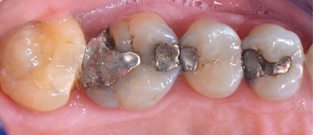 À propos d’une sinusite maxillaire chronique – L'Information Dentaire