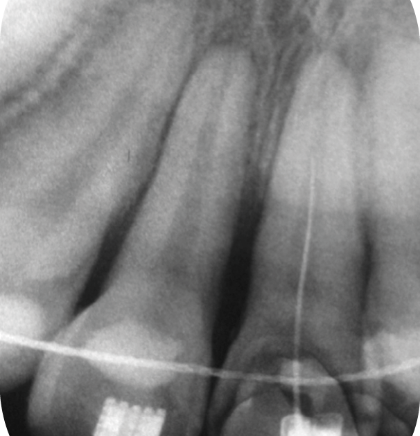 Les résorptions radiculaires externes post-traumatiques – L'Information ...