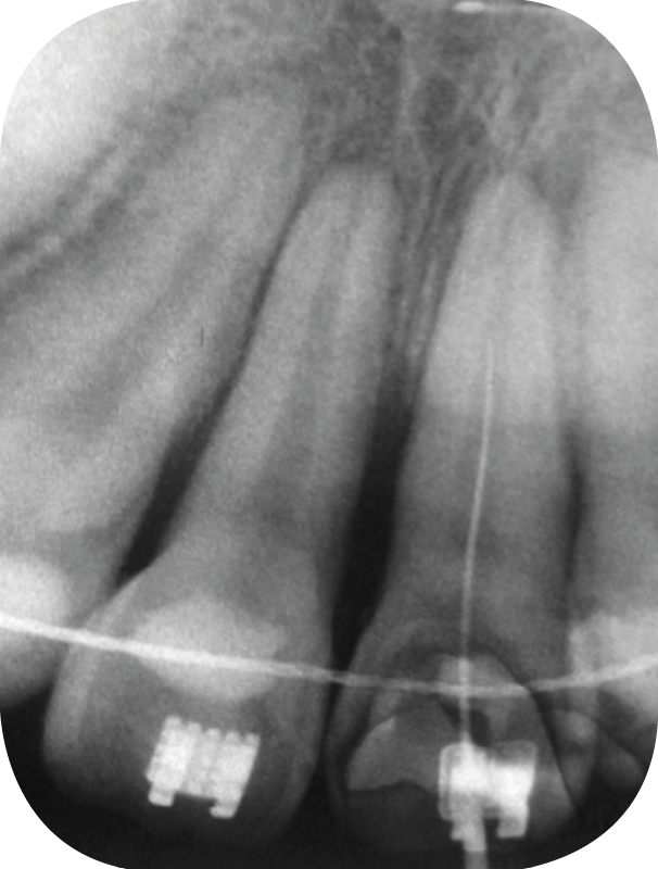 Les résorptions radiculaires externes post-traumatiques – L'Information ...