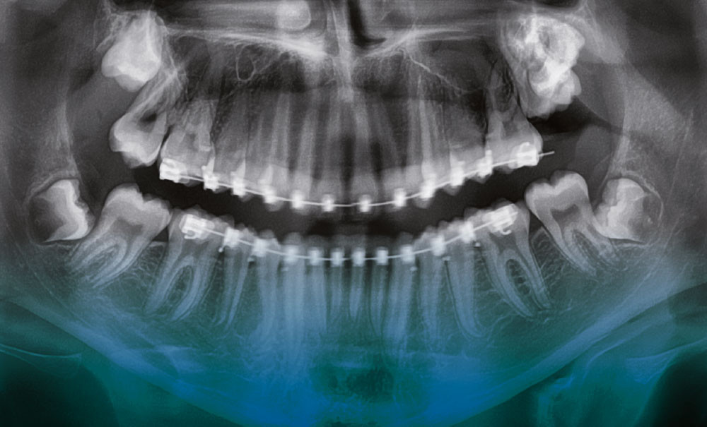 Les dents de sagesse en questions – L'Information Dentaire