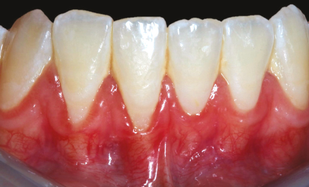 La prise en charge de la gingivite liée à la plaque – L'Information ...