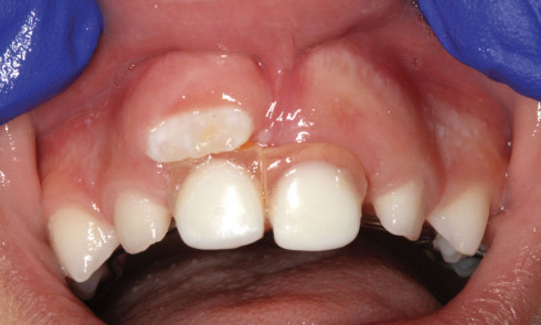 Les hypominéralisations molaires-incisives. Diagnostic et prise en ...