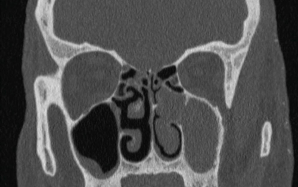 Échec du traitement d’une sinusite chronique maxillaire – L'Information ...
