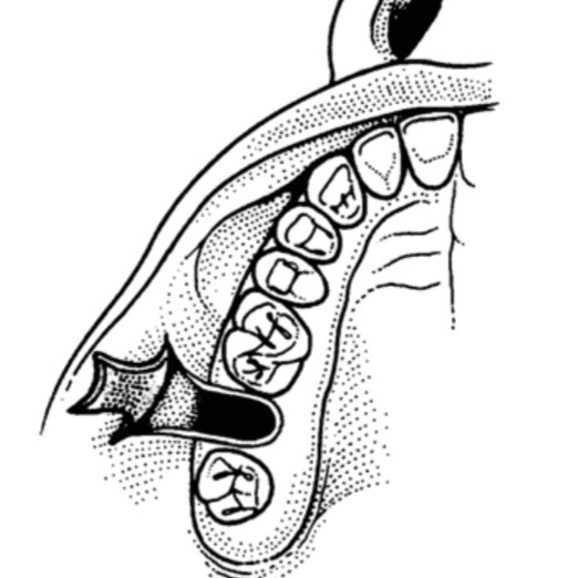 Chirurgie des fistules bucco-sinusiennes – L'Information Dentaire