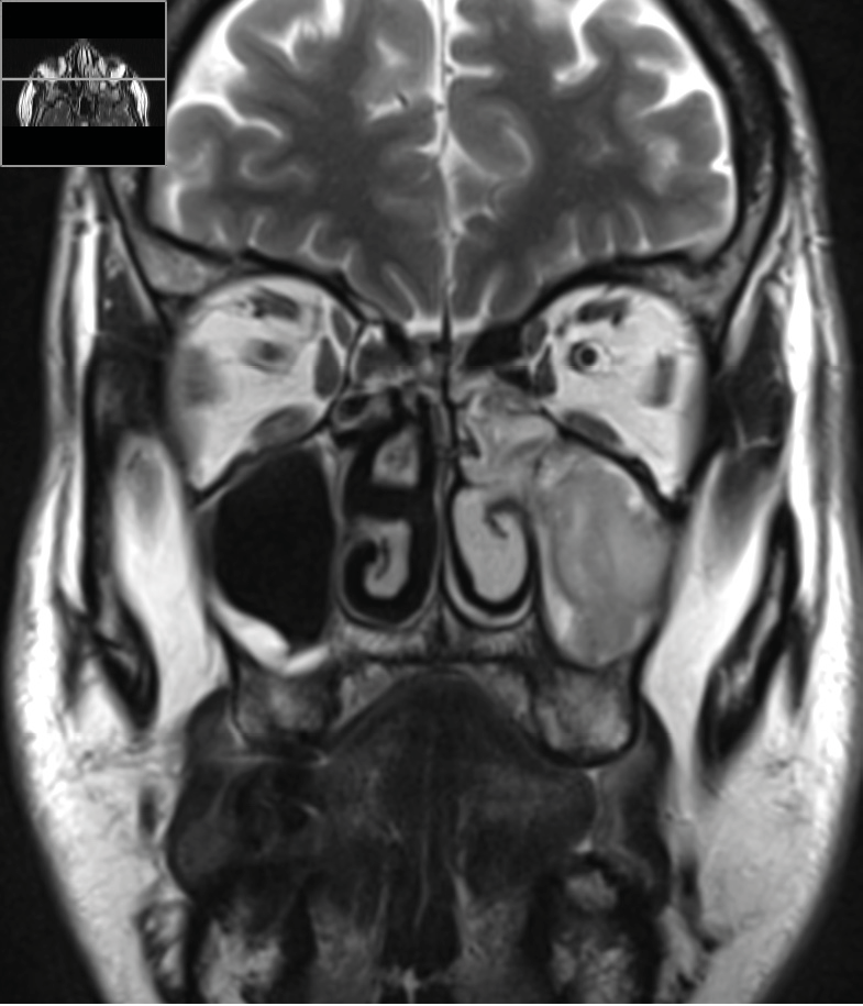 Échec du traitement d’une sinusite chronique maxillaire – L'Information ...