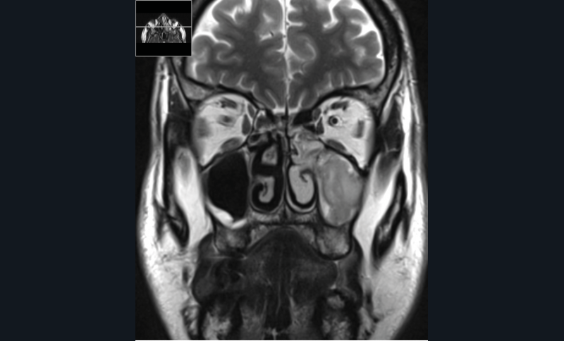 Échec du traitement d’une sinusite chronique maxillaire – L'Information ...