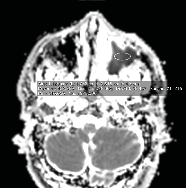 Échec du traitement d’une sinusite chronique maxillaire – L'Information ...