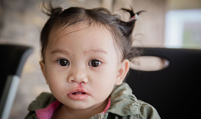 Fentes labio-palatines : les recommandations de la FDI – L'Information ...