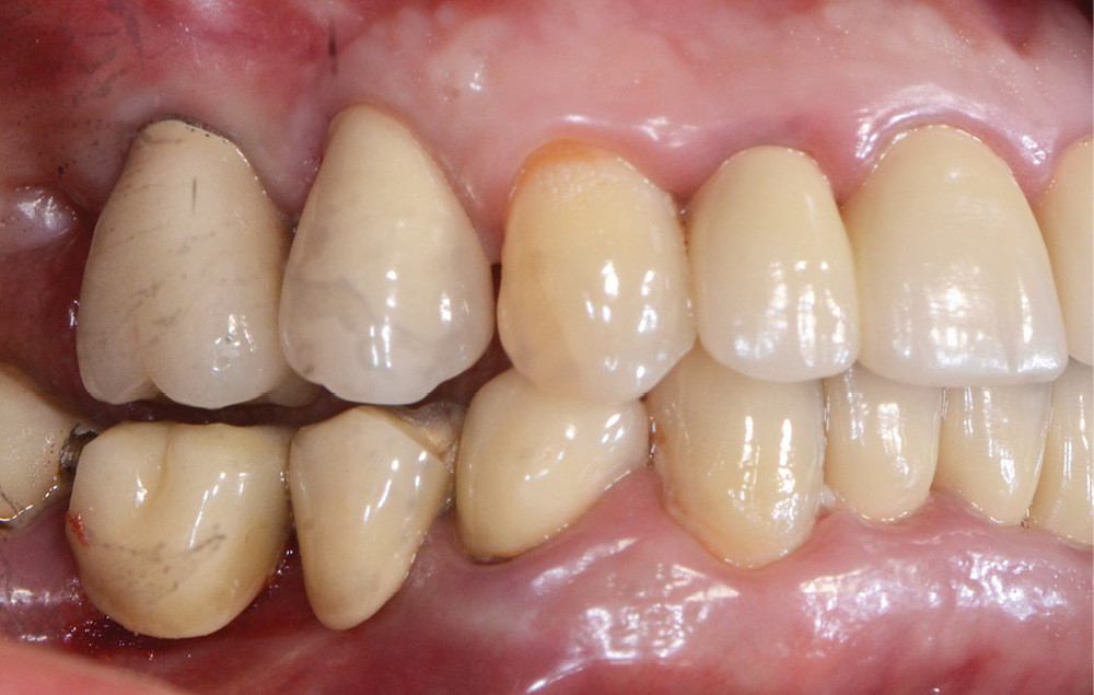 Équilibration occlusale raisonnée de la prothèse sur implant – L ...